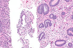 Benign endometrial polyp - Libre Pathology