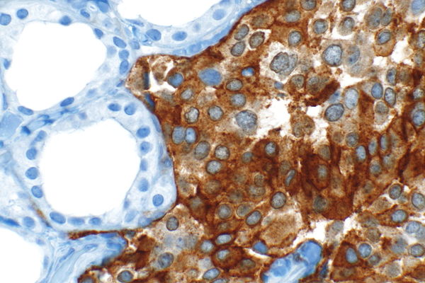 Carcinoembryonic antigen - Libre Pathology