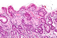 Gastric antral vascular ectasia - Libre Pathology