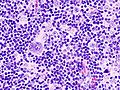 Hodgkin lymphoma - Libre Pathology