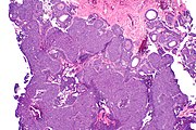 Adenomatoid odontogenic tumour - Libre Pathology