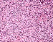 Trabecula - Libre Pathology