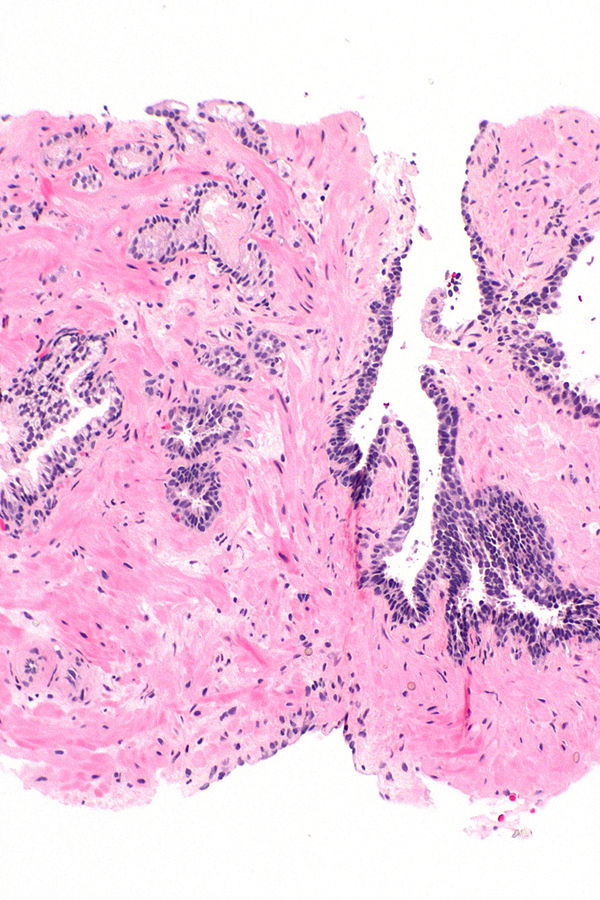 Atypical small acinar proliferation - Libre Pathology