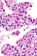Lymphocytic interstitial pneumonia - Libre Pathology