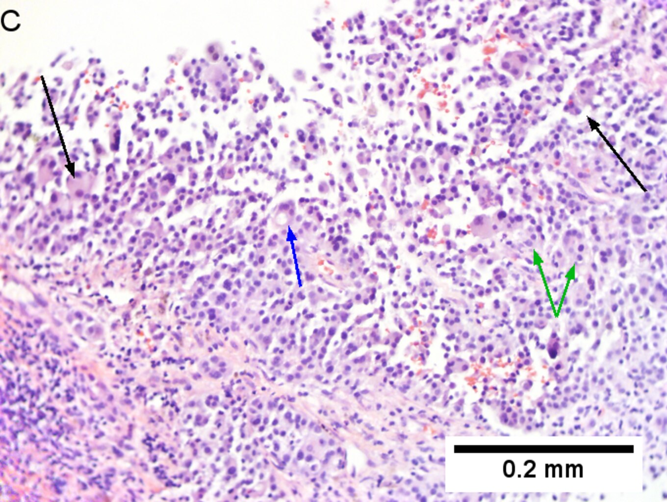 Liver metastasis - Libre Pathology