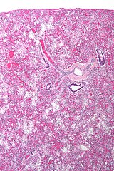 Diffuse alveolar damage - Libre Pathology