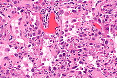 Multifocal micronodular pneumocyte hyperplasia associated with tuberous ...