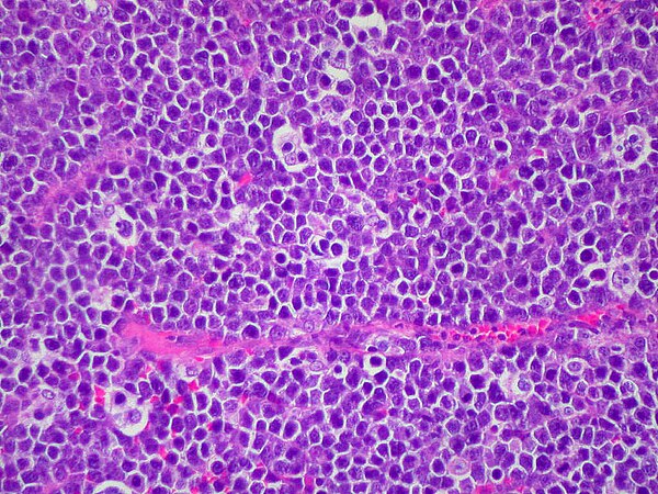 Burkitt lymphoma - Libre Pathology