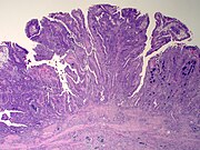 Gallbladder - Libre Pathology
