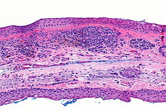Conjunctival nevus - Libre Pathology
