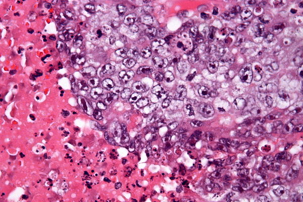 Embryonal carcinoma - Libre Pathology