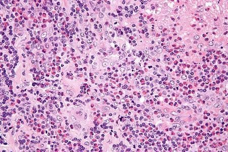 Kimura disease - Libre Pathology