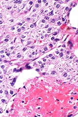 Parathyroid carcinoma - Libre Pathology