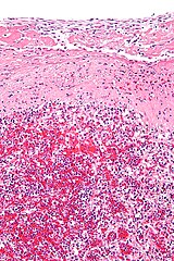 Spleen - Libre Pathology