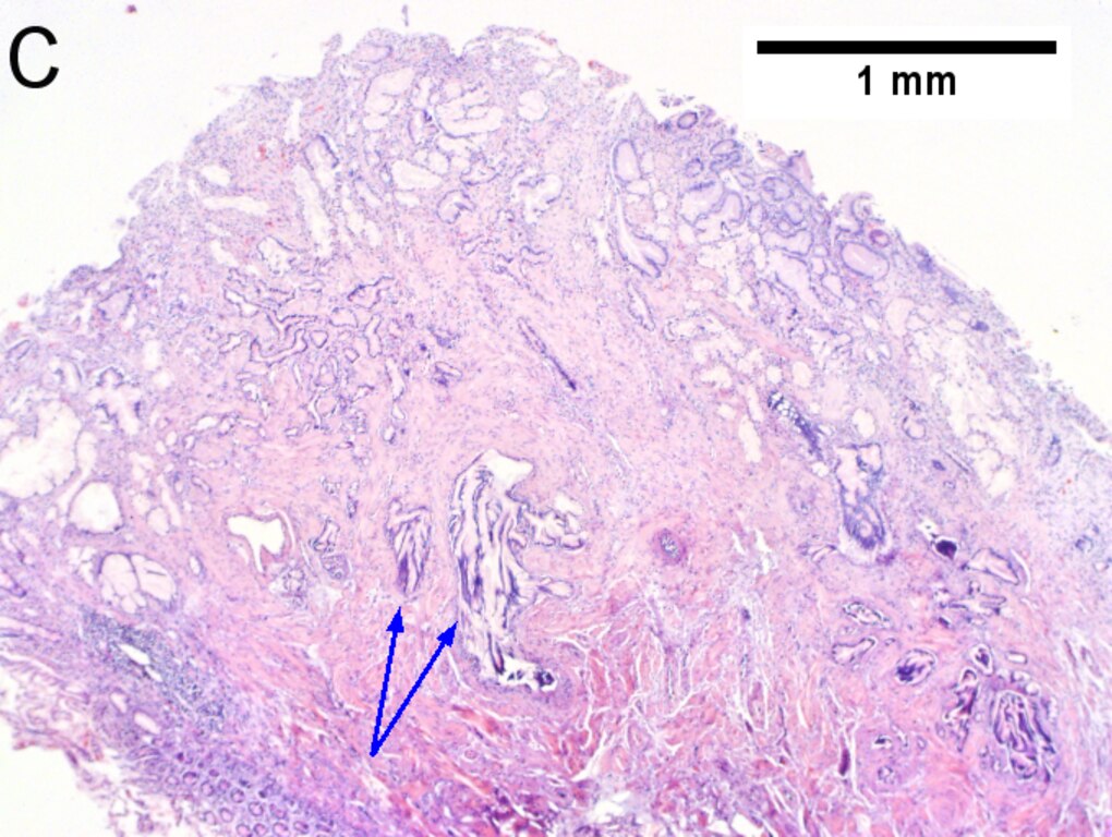 Ampulla of Vater - Libre Pathology