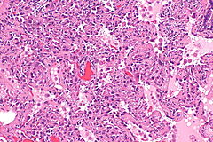 Multifocal micronodular pneumocyte hyperplasia associated with tuberous ...