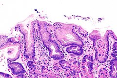 Sarcina - Libre Pathology