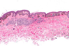 Compound nevus - Libre Pathology