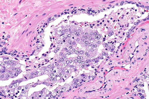 Intraductal carcinoma of the prostate - Libre Pathology