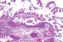 Foveolar type dysplasia - Libre Pathology