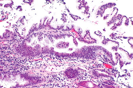 Foveolar type dysplasia - Libre Pathology