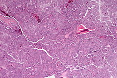 Solid pseudopapillary tumour - Libre Pathology