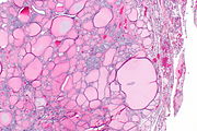 C-cell hyperplasia - Libre Pathology