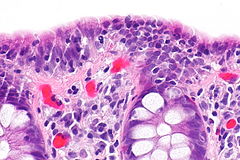 Lymphocytic colitis - Libre Pathology