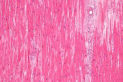 Rheumatic heart disease - Libre Pathology