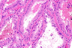 Fumarate hydratase-deficient renal cell carcinoma - Libre Pathology