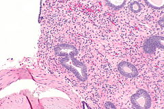 Benign endometrial polyp - Libre Pathology