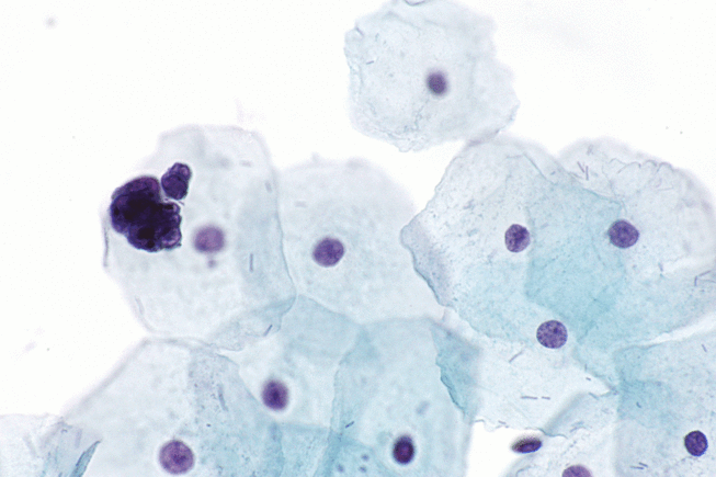 Quiz:Pap test 2 - Libre Pathology