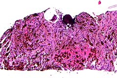 Schwannoma - Libre Pathology