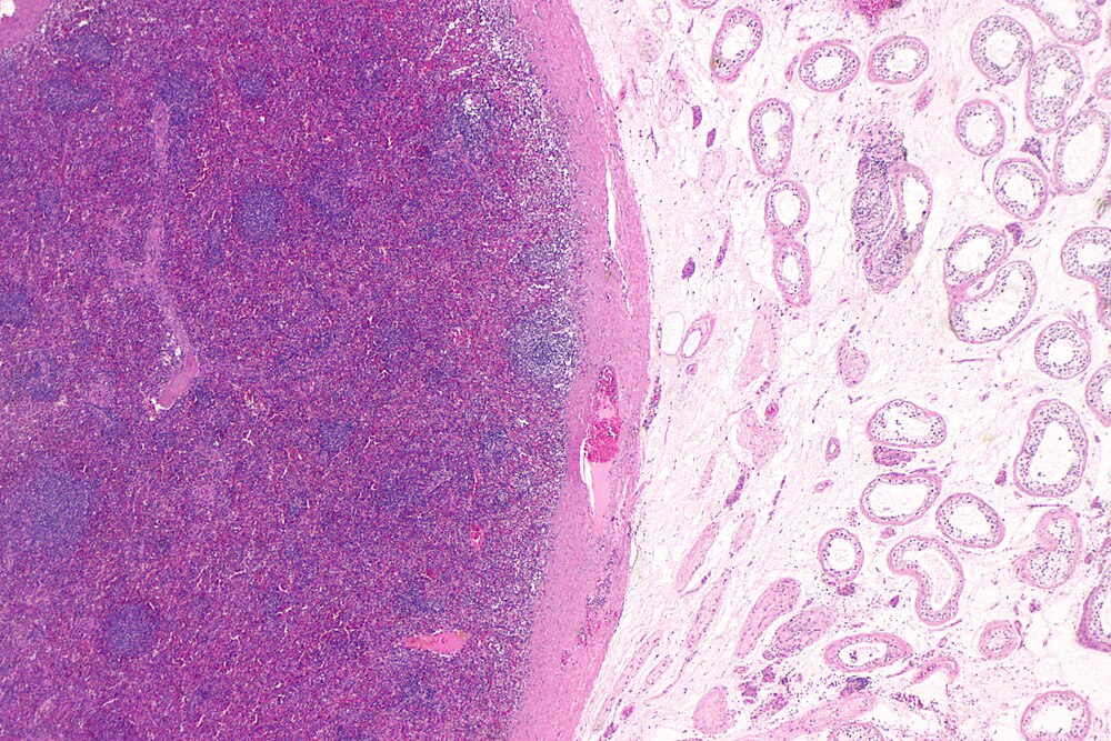 Case 87 - Libre Pathology