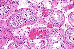 Germ cell neoplasia in situ - Libre Pathology