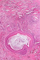 Squamous metaplasia of lactiferous ducts - Libre Pathology