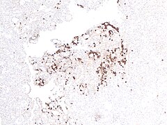Secretory carcinoma of the salivary gland - Libre Pathology