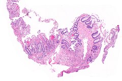 Radiation colitis - Libre Pathology