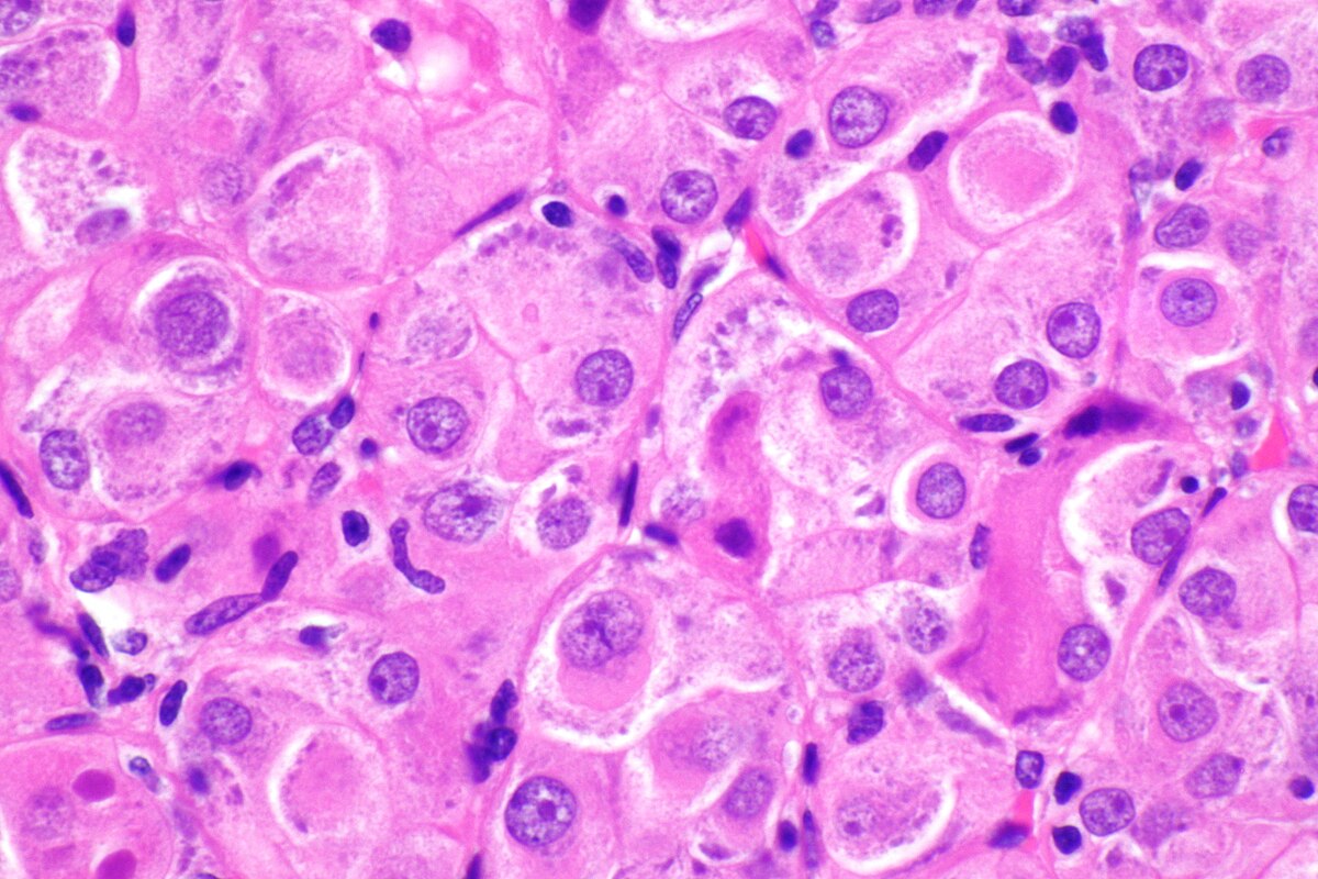 File:Eosinophilic, solid and cystic renal cell carcinoma - 2 -- very ...