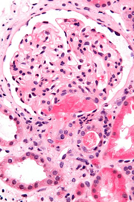 Thrombotic microangiopathy - Libre Pathology
