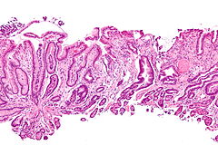 Gastric antral vascular ectasia - Libre Pathology
