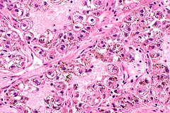 Melanotic Xp11 translocation renal cancer - Libre Pathology