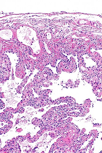 interstitial pneumonia