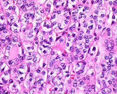 Noninvasive follicular thyroid neoplasm with papillary-like nuclear ...