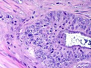 Gallbladder - Libre Pathology