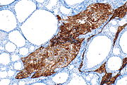 C-cell hyperplasia - Libre Pathology