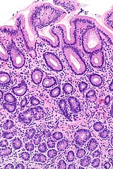 Autoimmune metaplastic atrophic gastritis - Libre Pathology