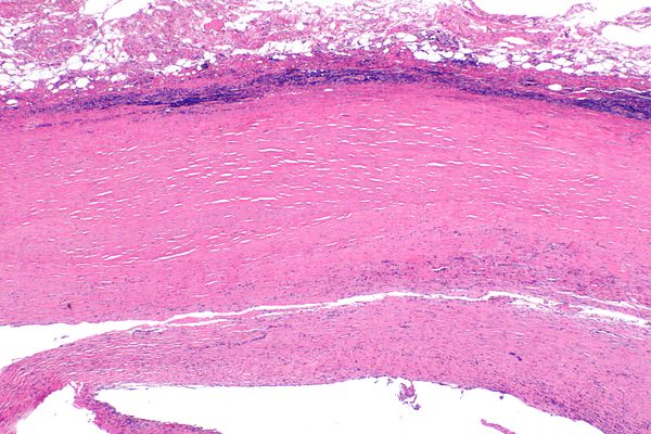 Pleural plaque - Libre Pathology
