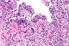 Radiation changes - Libre Pathology