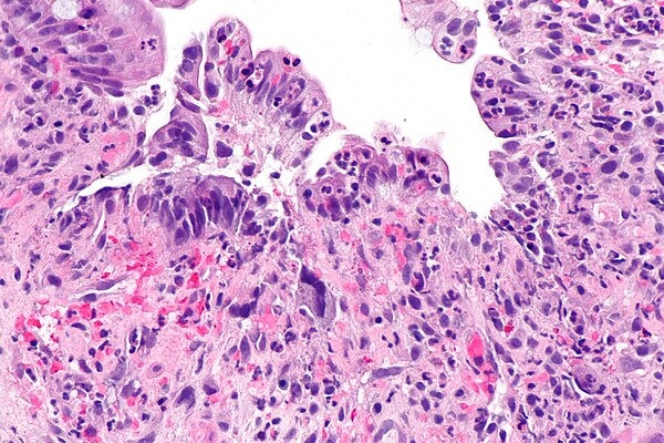 Radiation colitis - Libre Pathology